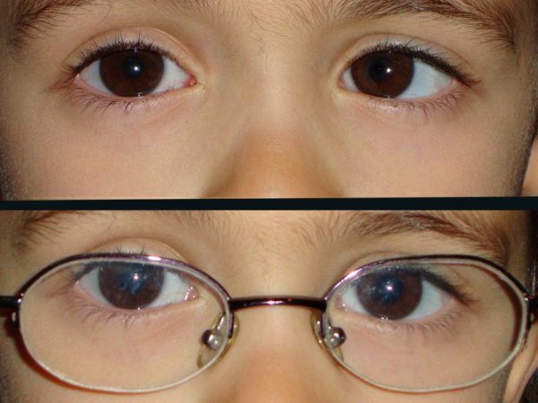 درمان انحراف چشم - روشنا اپتیک