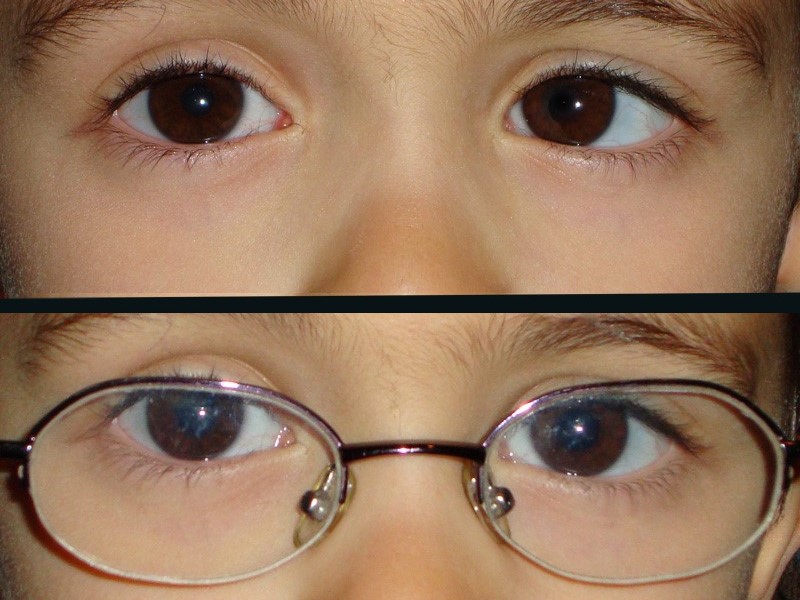 درمان انحراف چشم - روشنا اپتیک