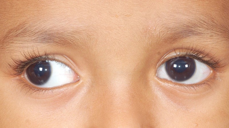 درمان انحراف چشم - روشنا اپتیک